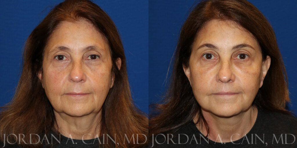 Surgical Before-and-After | Texas Facial Aesthetics