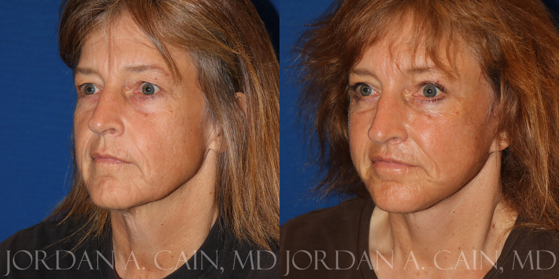 252981 | Texas Facial Aesthetics