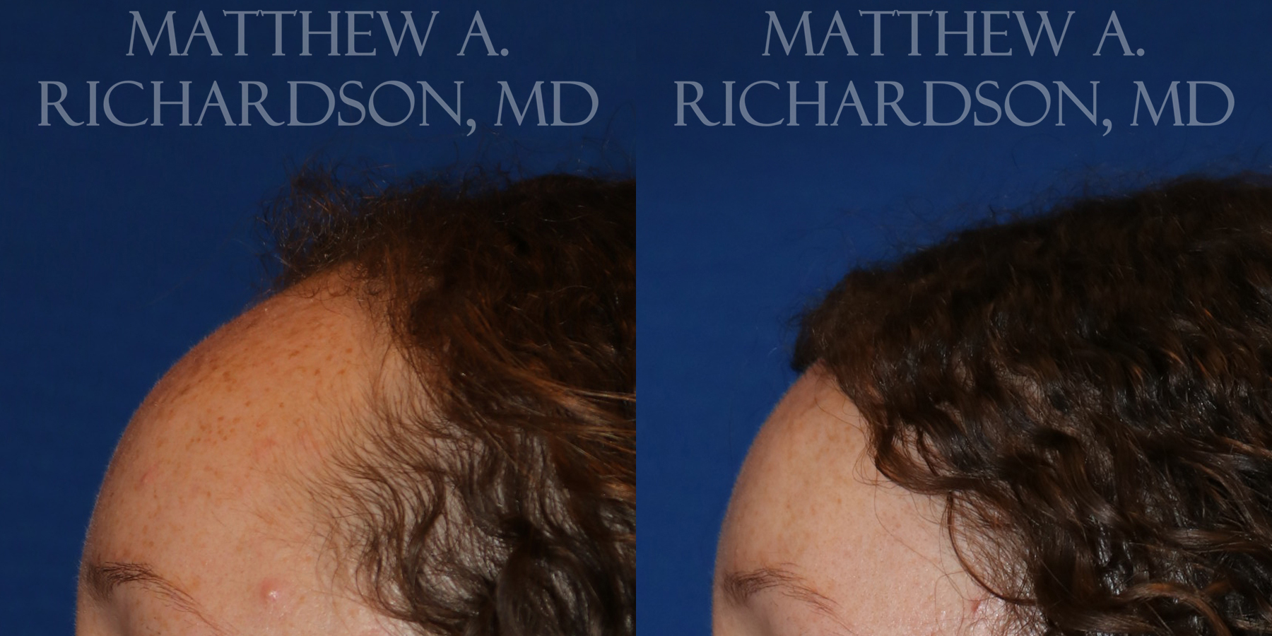 Hairline Lowering Before & After Photos Patient #254119