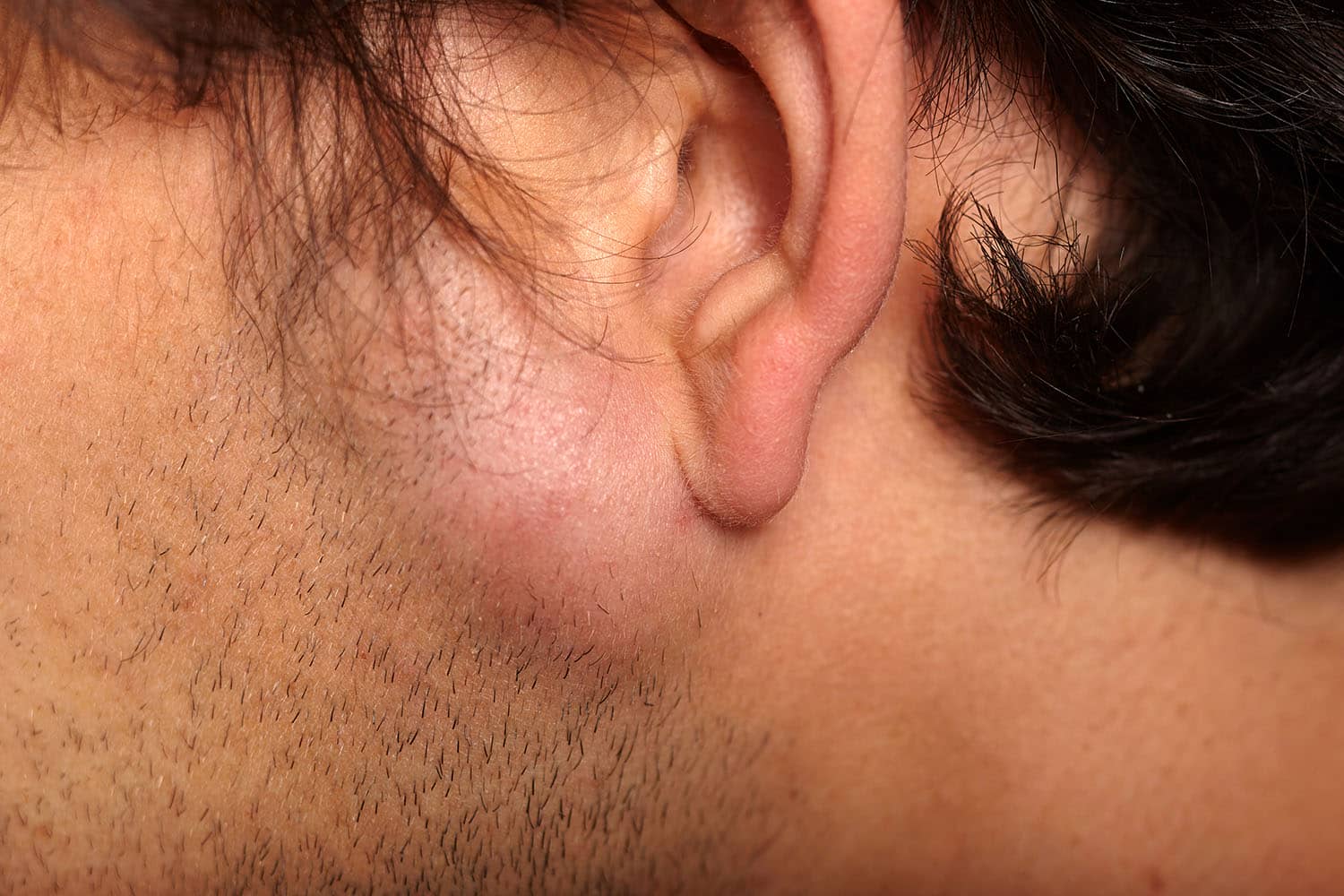 What Causes Fatty Lumps On Face Infoupdate What Causes Fatty Lumps On Face Infoupdate