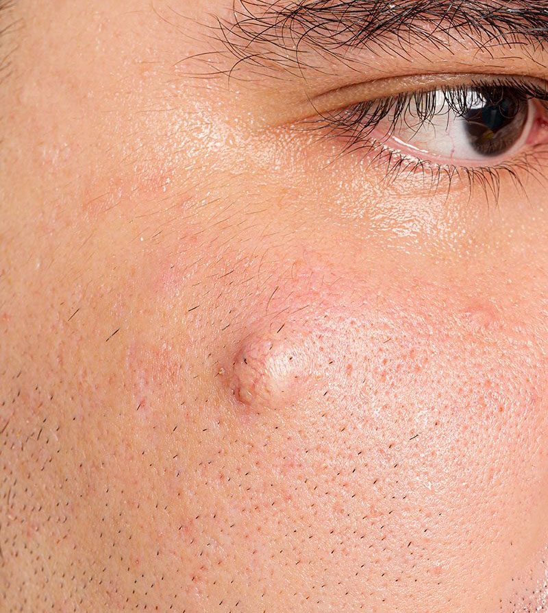 What Causes Fatty Lumps On Face Infoupdate